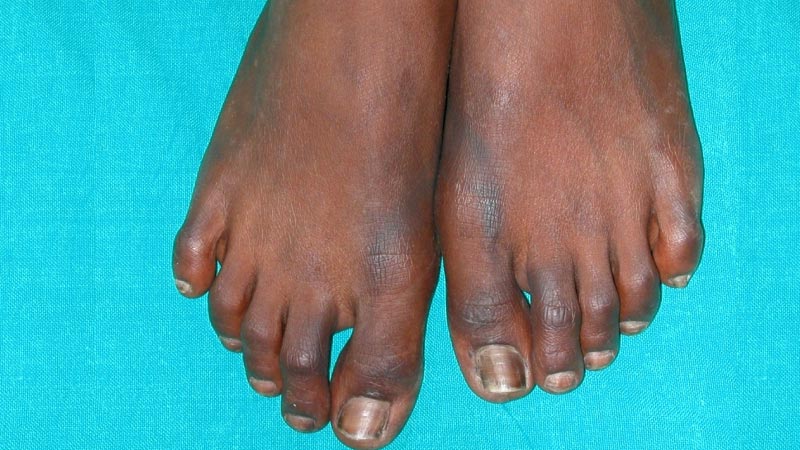 Enfermedad de Addison: ¿síntomas y causas de la insuficiencia ...